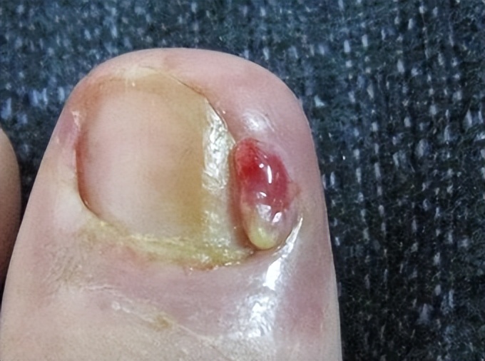 What department should paronychia go to the hospital for?What to do if ...