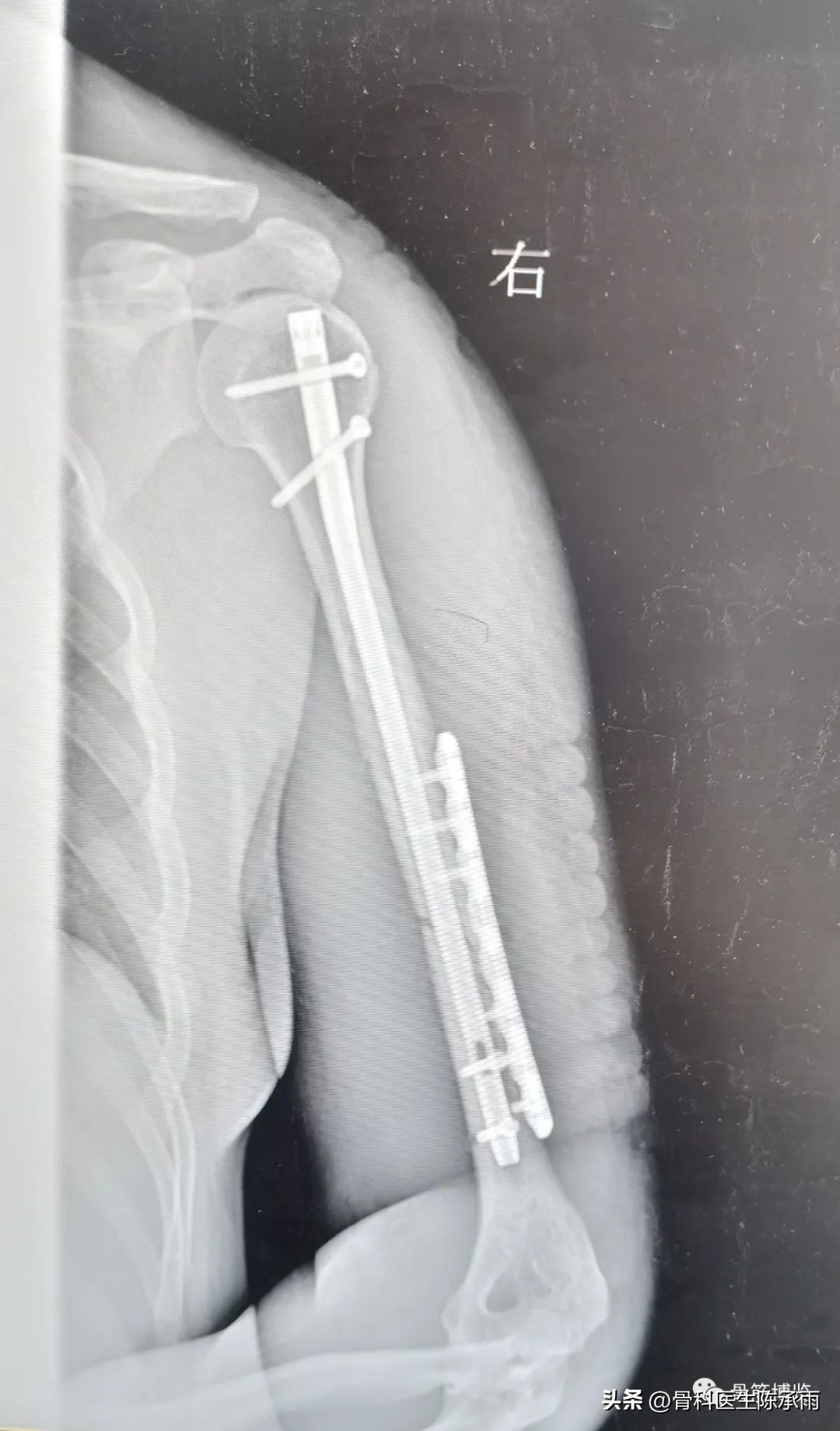 Internal fixation of humerus fractures with interlocking screws - iNEWS