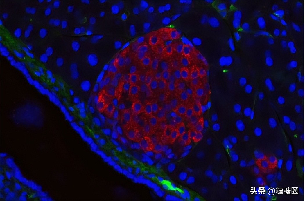 A new method of islet transplantation enables diabetic patients to ...