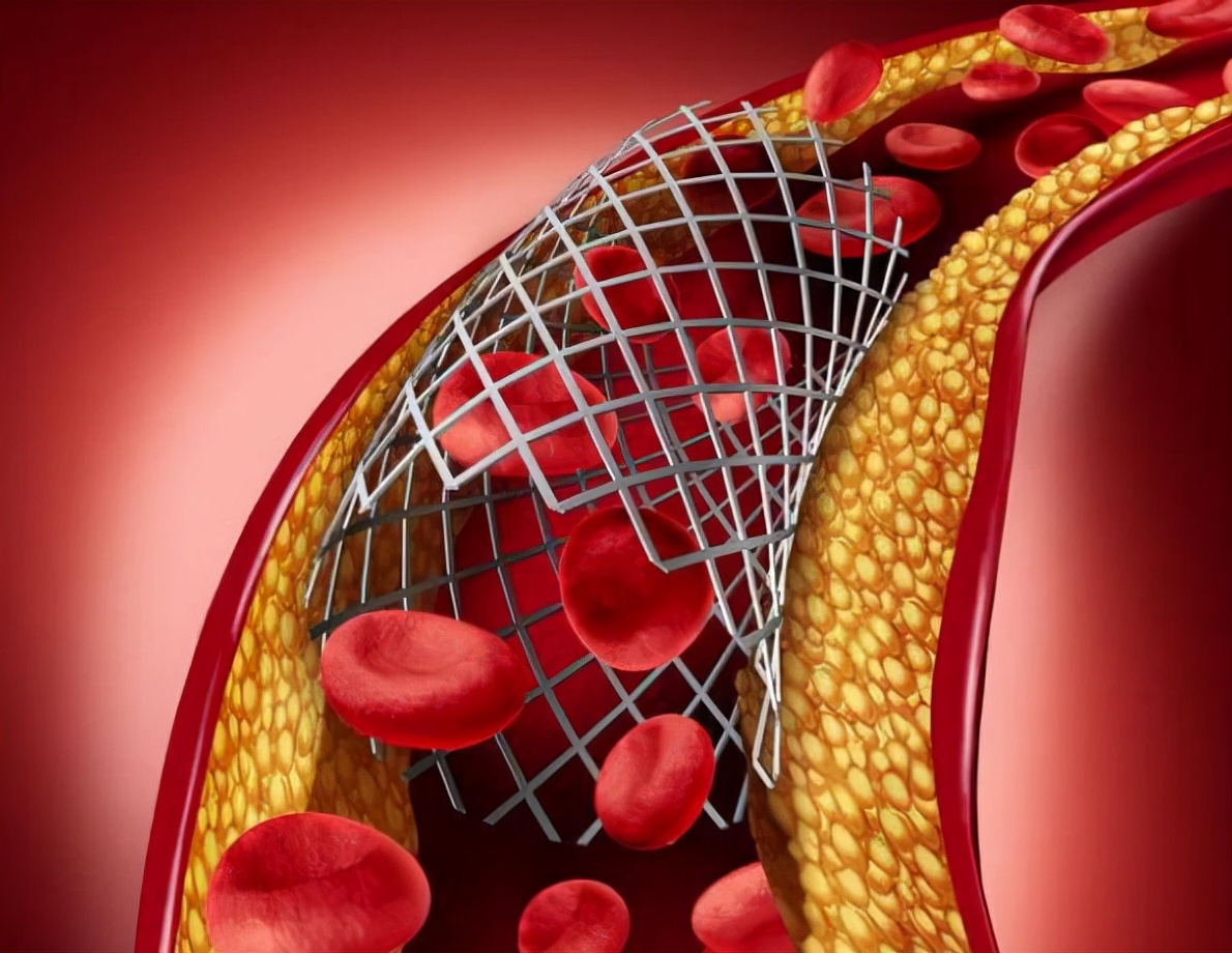 Is the heart stent "harmful" or "saving"?If you pretend to be a human ...