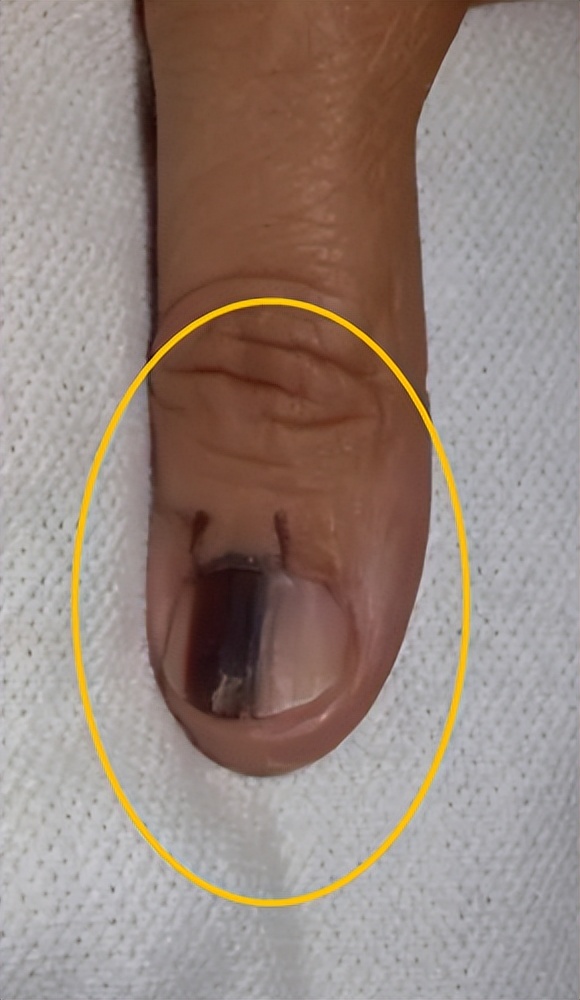 6 kinds of nail conditions are made public, understand physical ...
