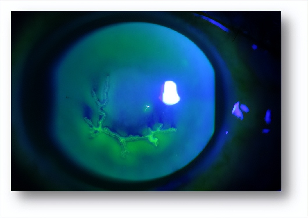 Prof. Gong Lan: Clinical features and treatment strategies of corneal ...