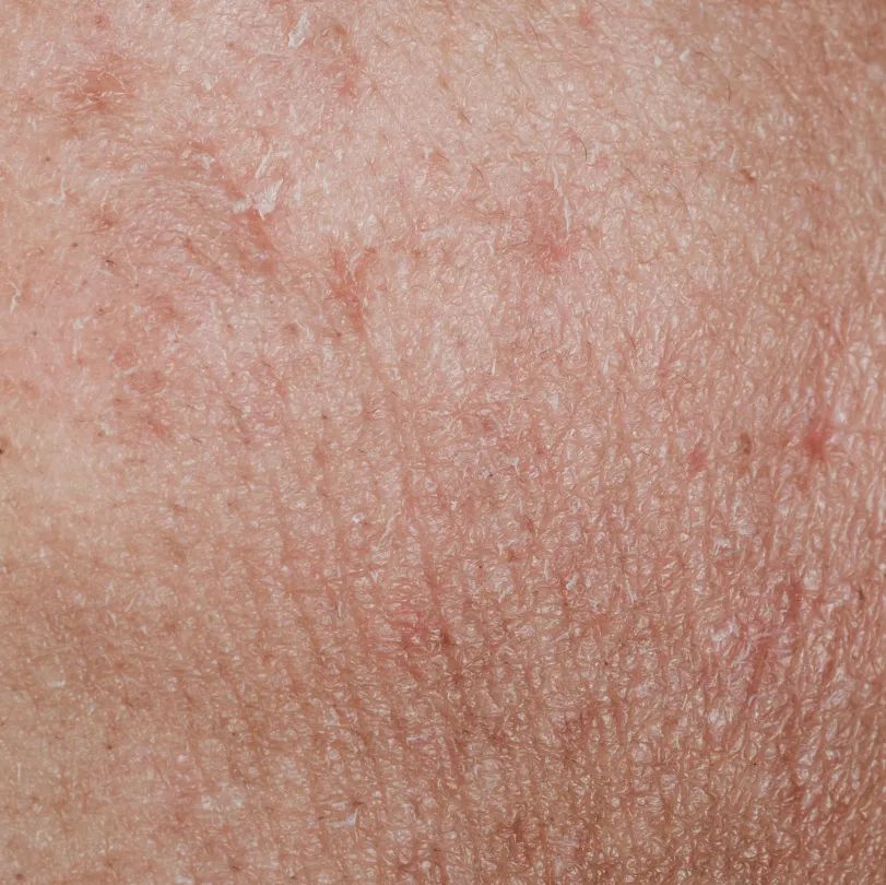 How to deal with the challenges of fragile and sensitive skin in the ...