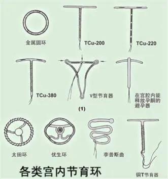 The human body "travel" of the IUD - iNEWS