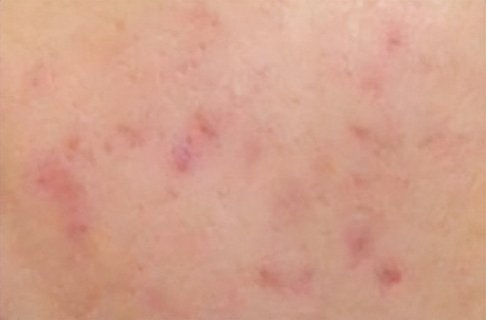 How do acne scars form on the face?Can it return to normal skin after ...