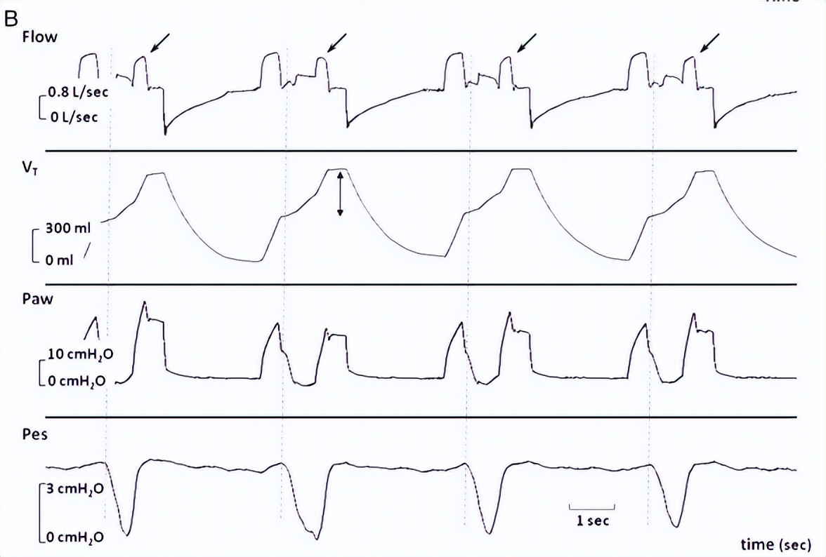 Professor Luo Hong: How to identify "reverse trigger" during mechanical ...