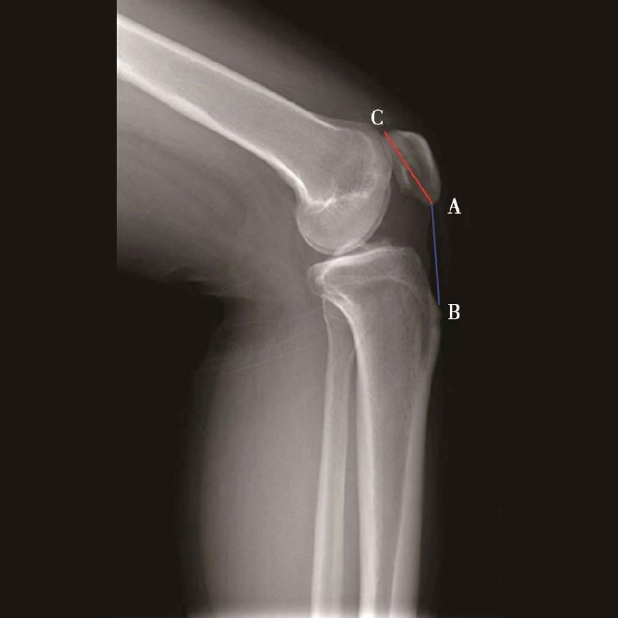 Radiographic evaluation of patellar height and patellar trochlear - iNEWS