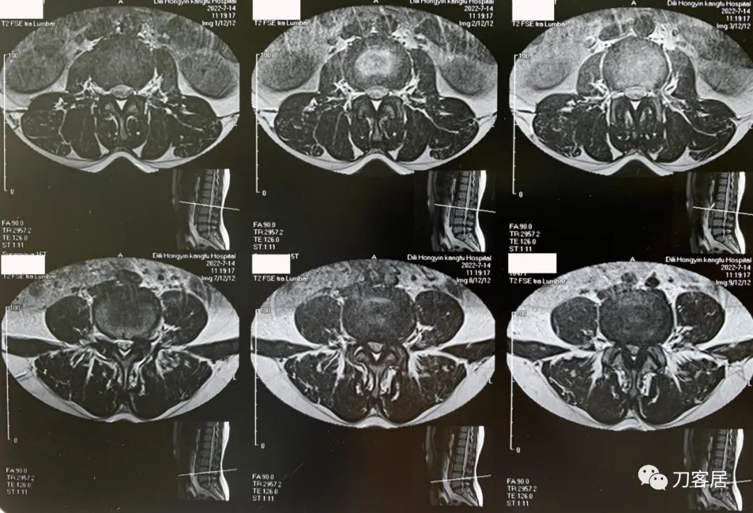 A 50-year-old woman has numbness in her left leg, unable to sit, severe ...