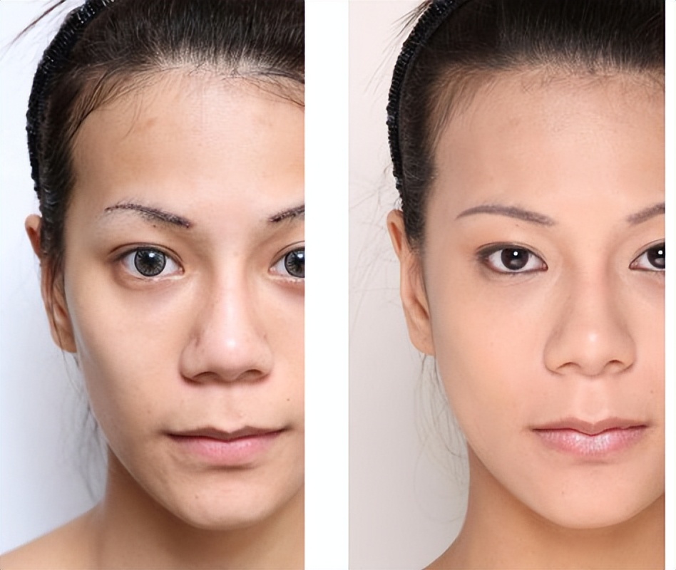 The temples are uneven, and the effect after filling is completely ...