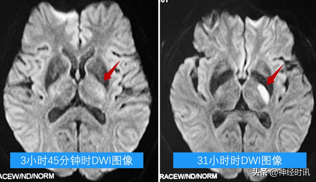 It is obviously an acute cerebral infarction, why can't DWI see the ...