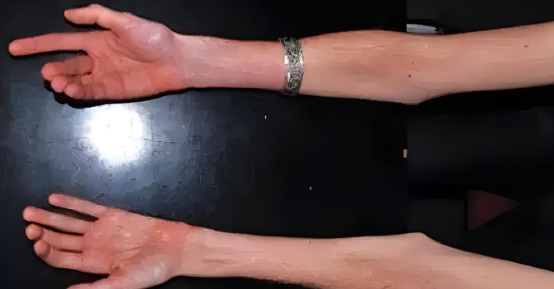 Sudden twitching of limbs, limb movement disorders, more and more slender, beware of flail arm ...