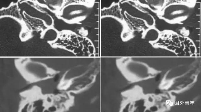 Common Abnormal Temporal Bone CT Summary - iNEWS