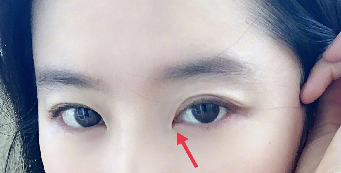 What's going on with those female stars who seem to have "cross-eyed ...