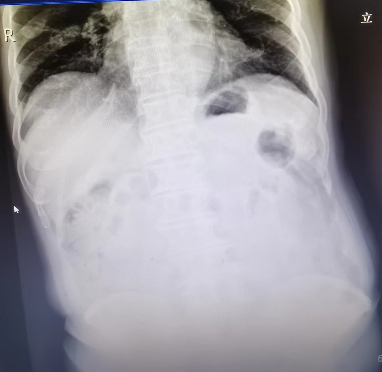 Faecal water has been flowing from the anus, not necessarily "fecal ...