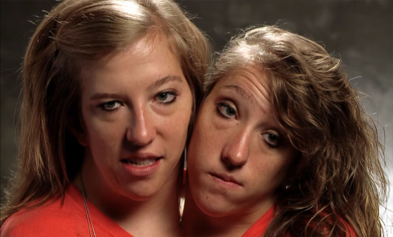 Conjoined twins share exciting news, no one thinks death is imminent ...