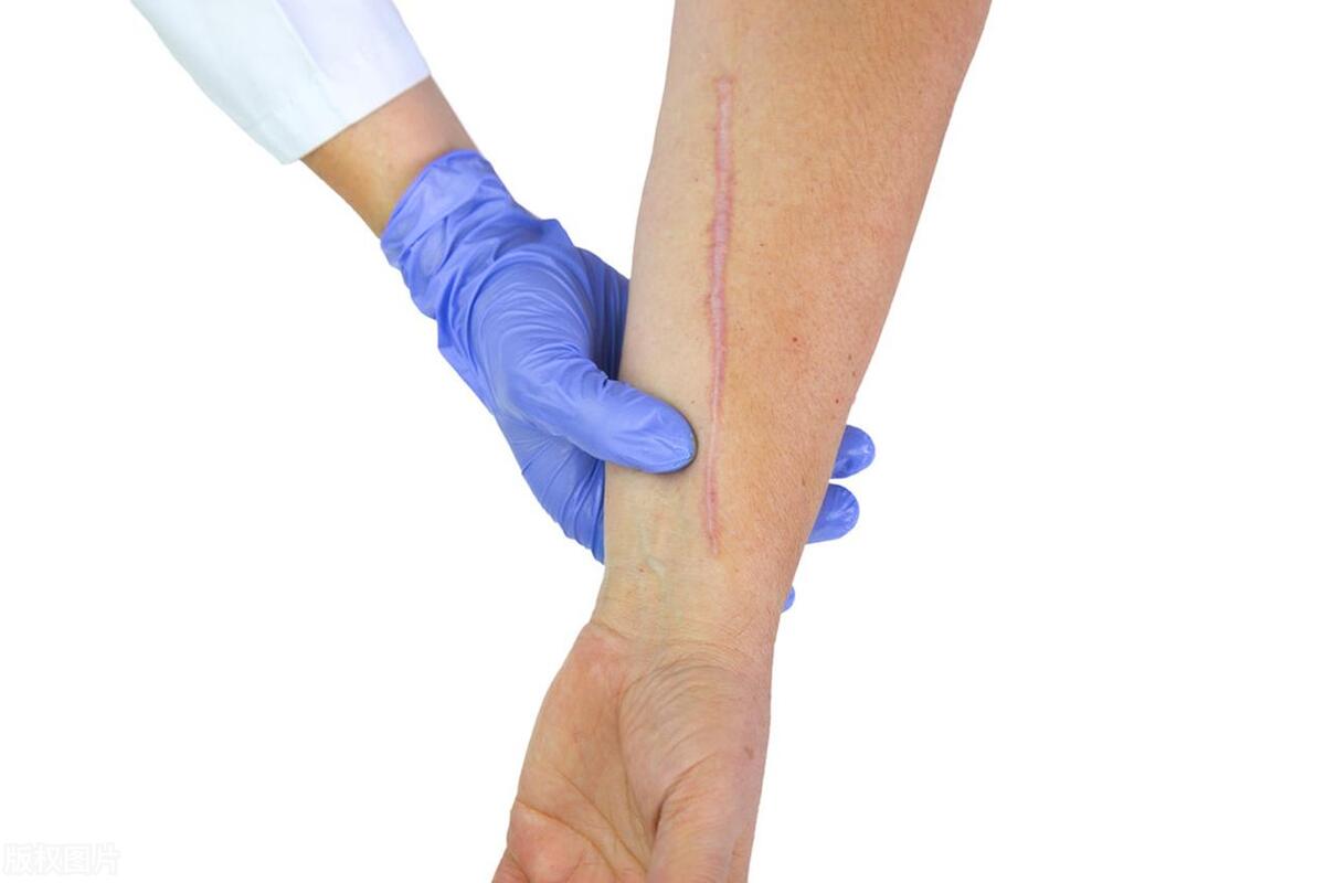 Scar Secrets: How to Lighten and Heal Scars Effectively - iMedia