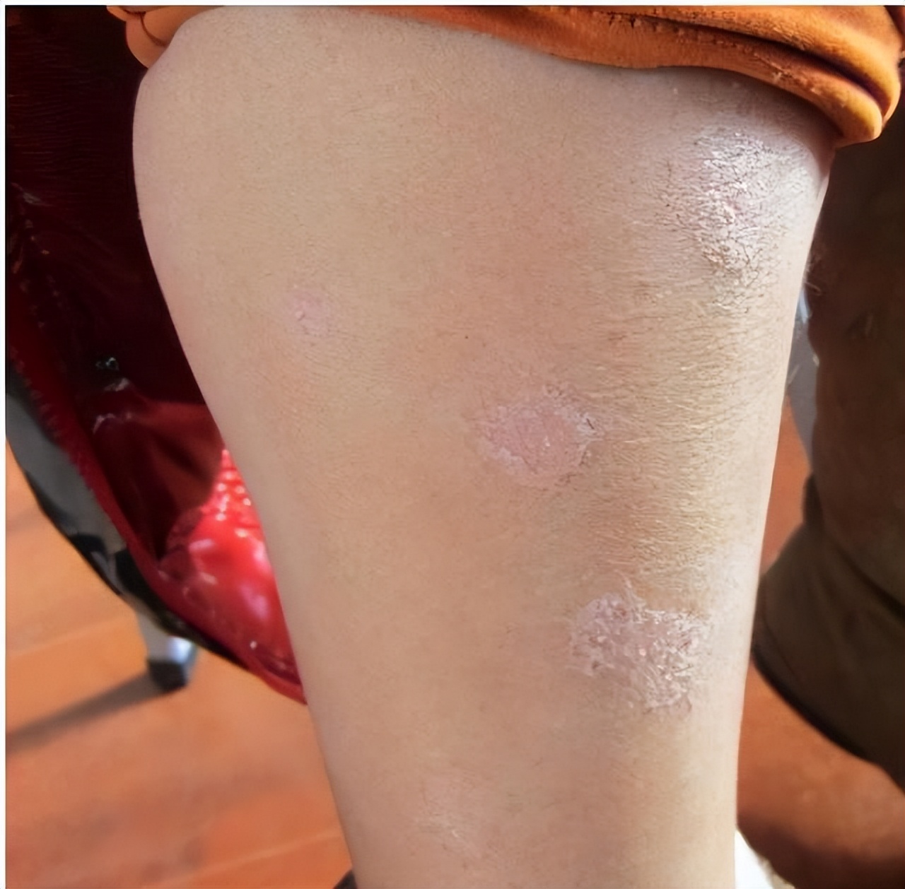 What is psoriasis? What are the symptoms? It is easy to find these 3 ...