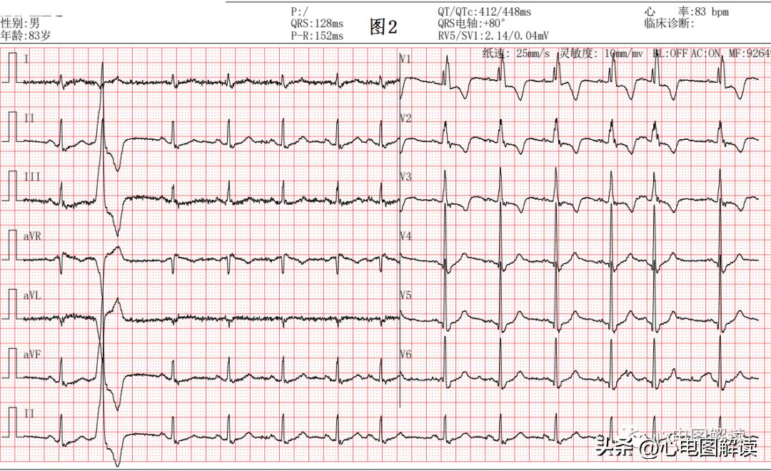 Complete right bundle branch block in 6 cases - iNEWS