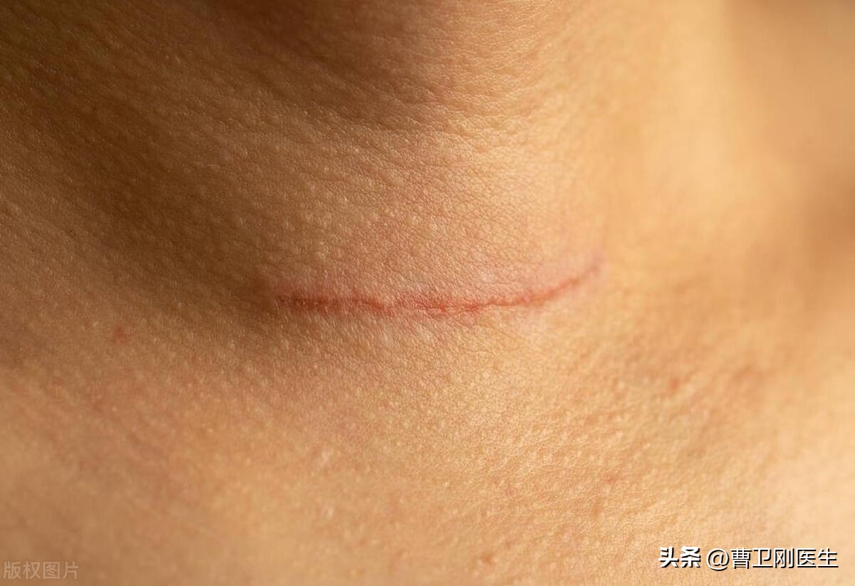 Thermal ablation: a case of reoperation after ablation therapy for ...