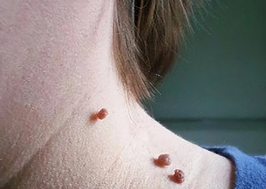 What are the "little fleshy bits" on the neck and underarms?Can it be ...