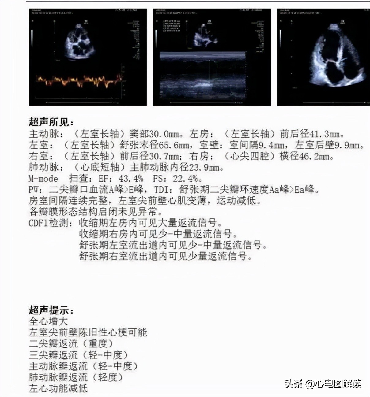 Multifocal ventricular tachycardia? - iNEWS
