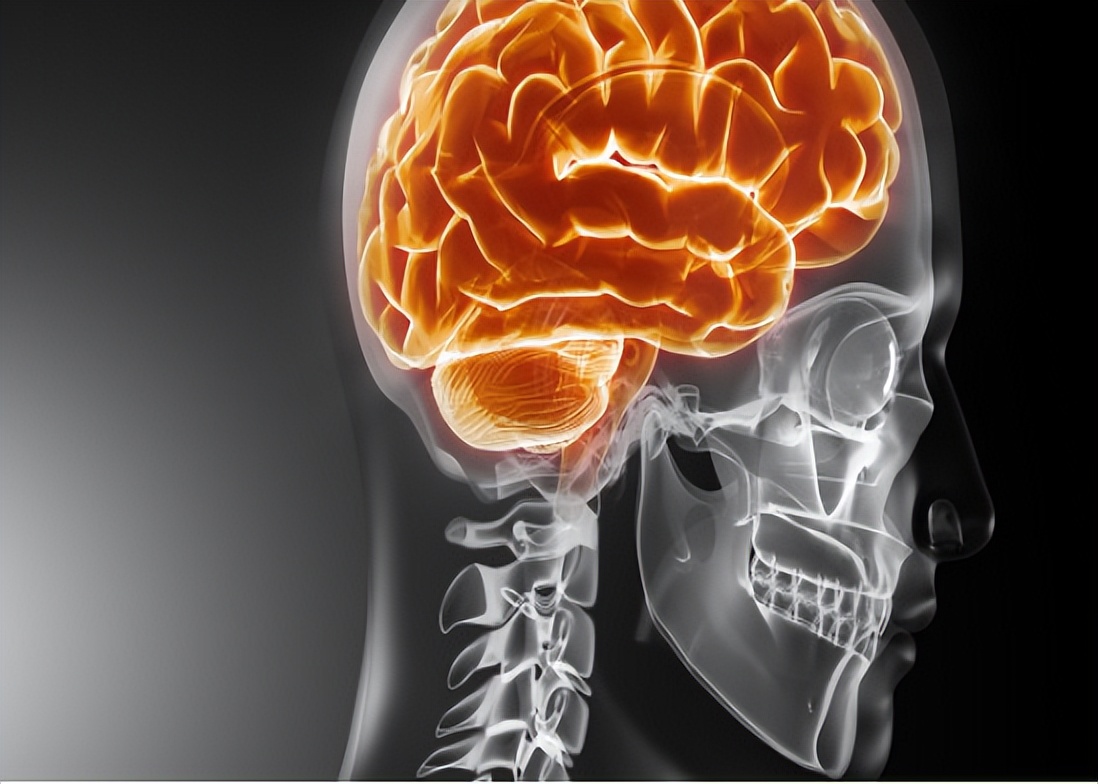 Chinese people are most prone to cerebral infarction, and atrial ...