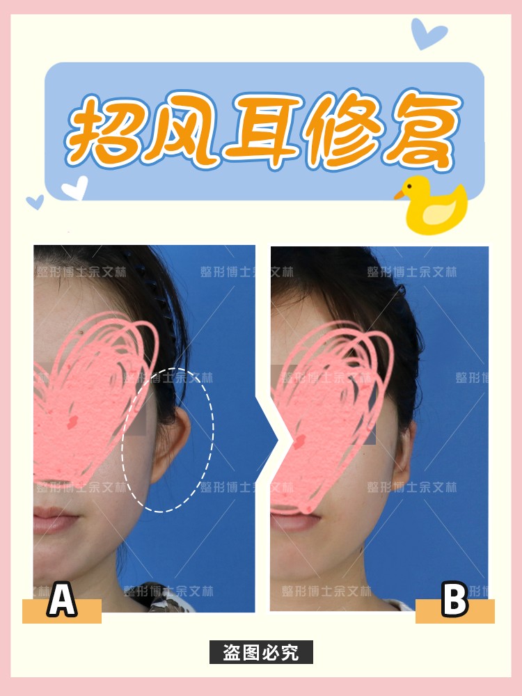 Are "popular" ape ears attracting wind?What is the difference between ...