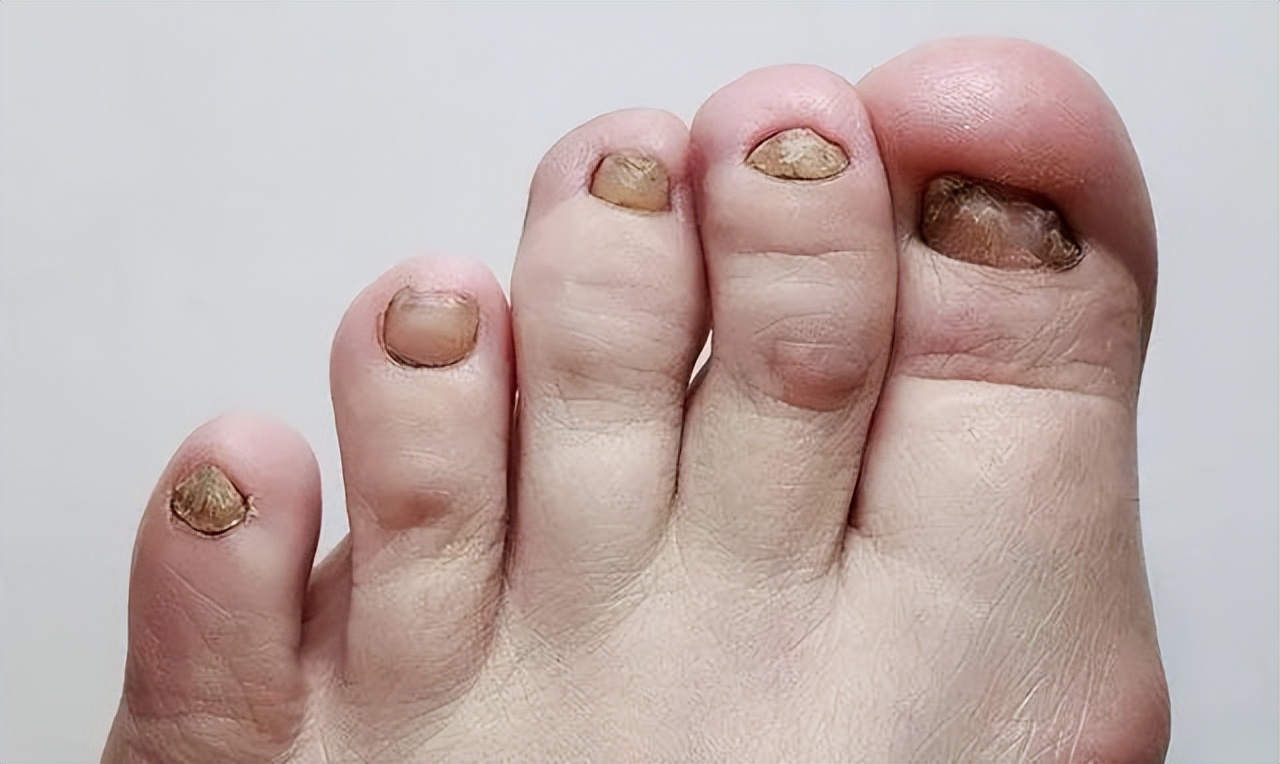 What is the origin of the person whose little toe fingernail is divided ...