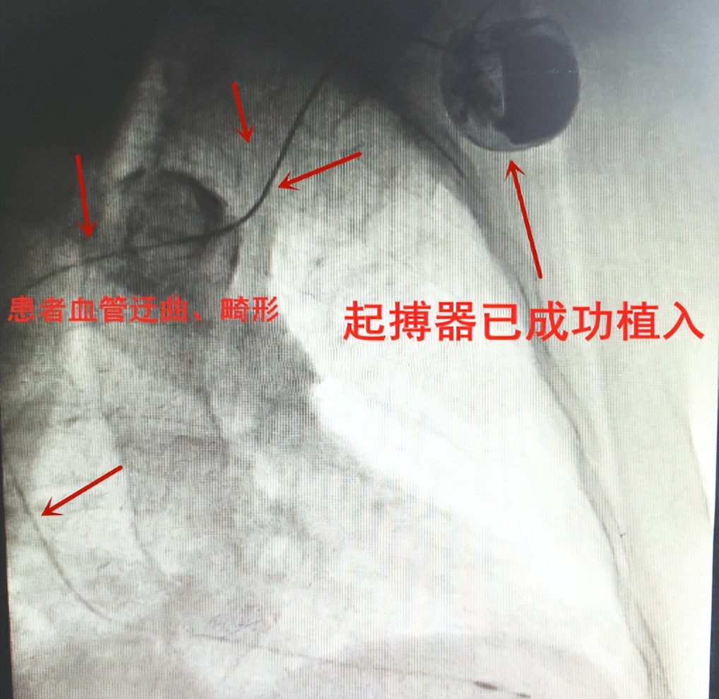 Break through the super-senile taboo! 97-year-old man successfully ...