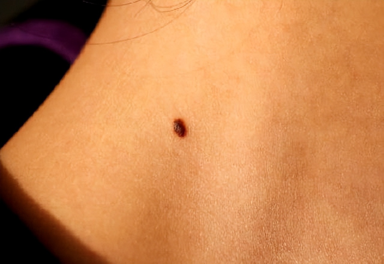 Why do people get moles? - iNEWS