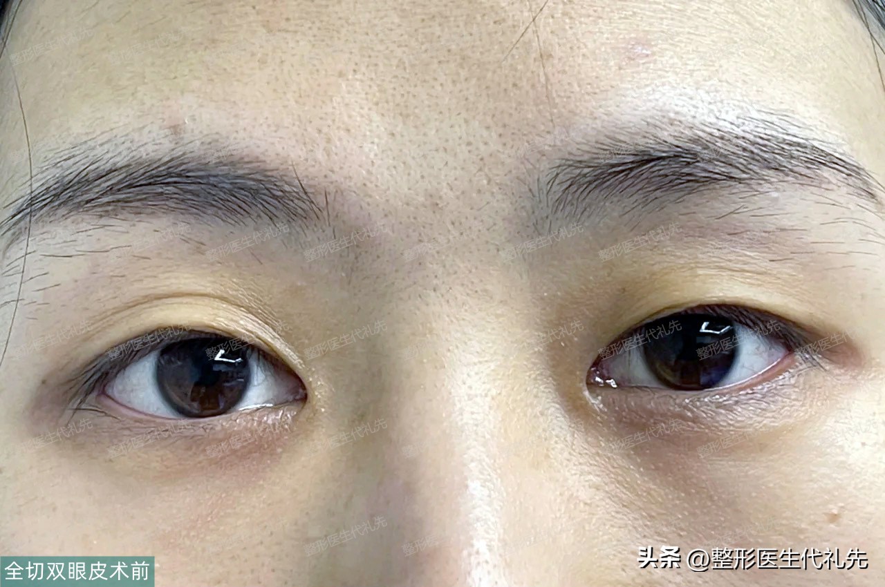 I have always wanted to have beautiful Danfeng eyes, and I finally ...