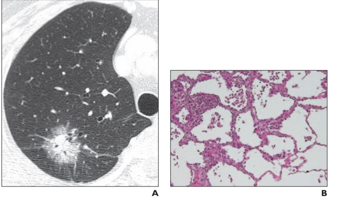 Differential diagnosis of pulmonary nodules - CT case with pathological ...