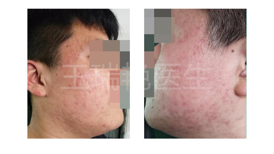 Can acne pits be treated with pure medicine?This case tells you - iNEWS