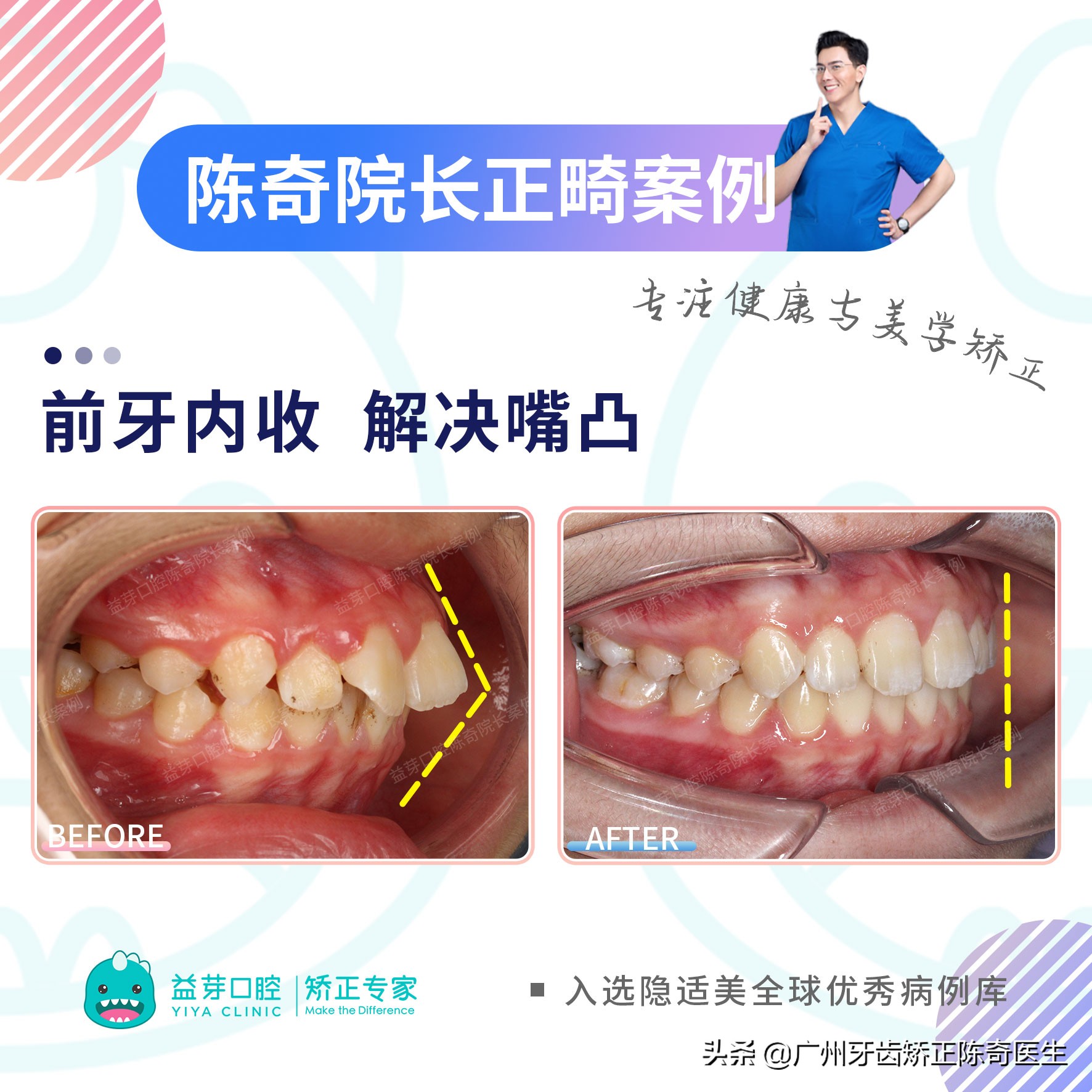12-year-old girl with maxillary lordosis + crowded teeth, combined ...