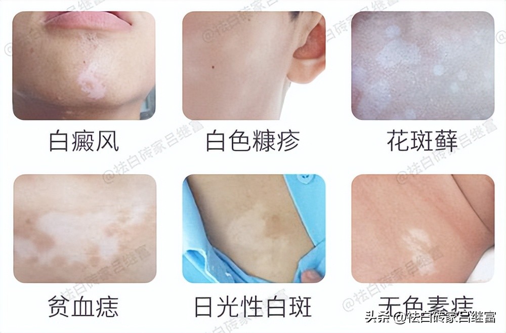 Slight vitiligo at the beginning, what is the disease?How to judge fast ...