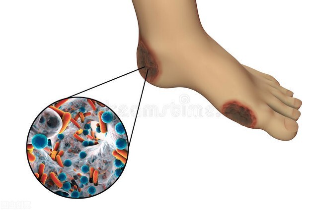Diabetic feet are called "old and rotten feet." What will happen if the ...