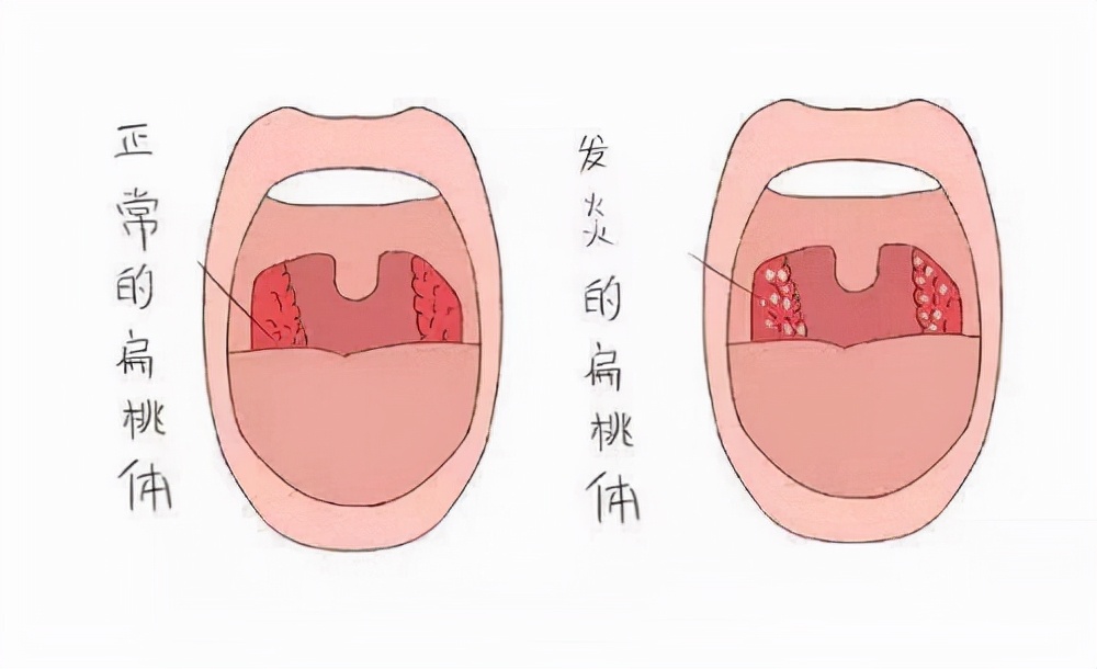 What should I do if my tonsils become inflamed repeatedly?Reminder ...