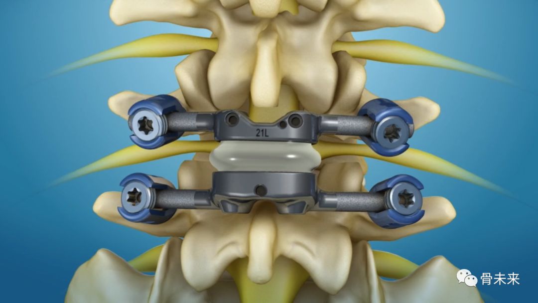 New Orthopedic Technology!Alternatives to Spinal Fusion Surgery - iNEWS