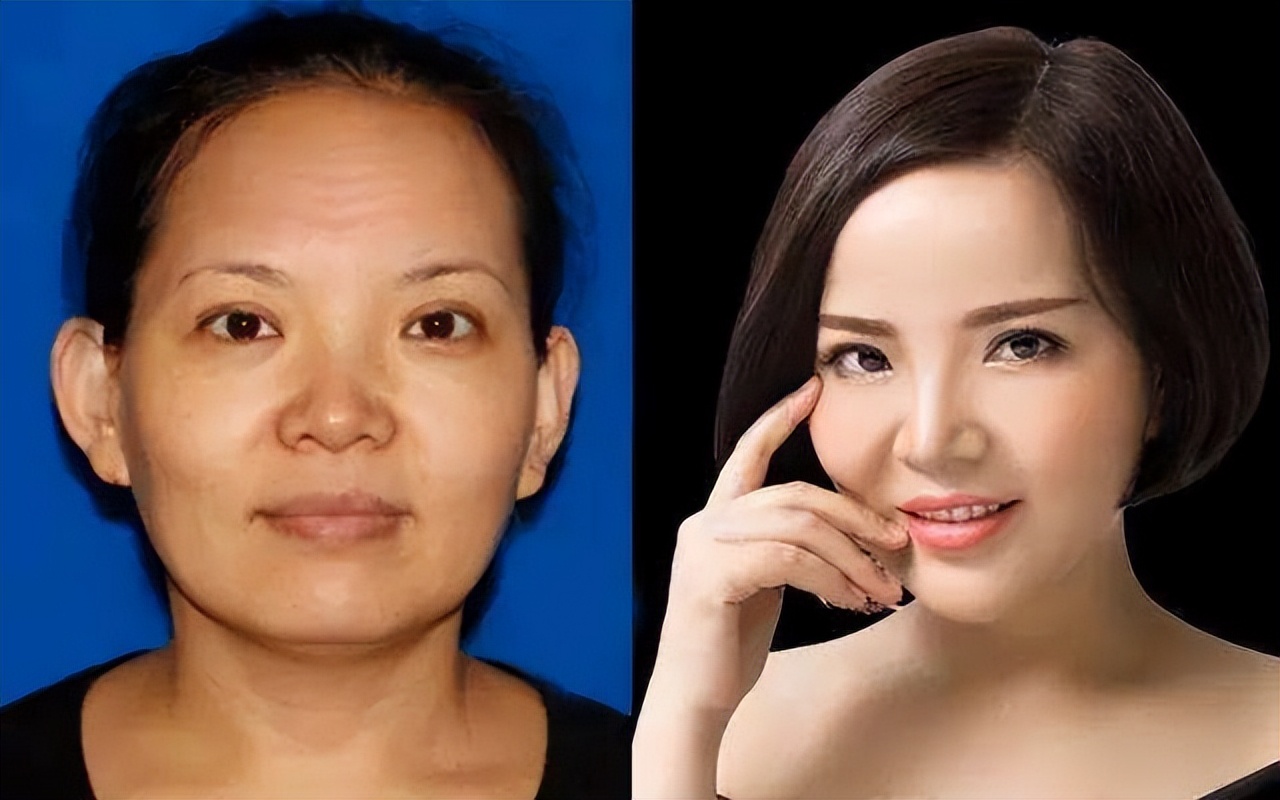 Xie Yilin admitted to plastic surgery, saying that the crooked and flat ...