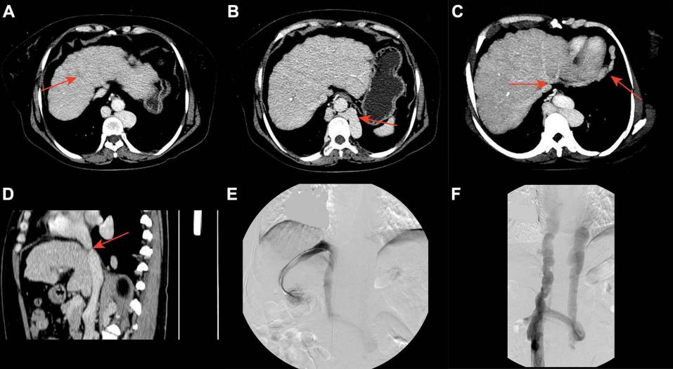 Clinical features and CT imaging analysis of hepatic sinusoidal ...