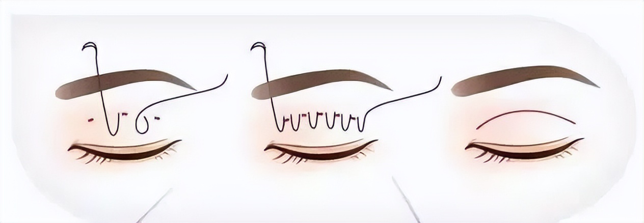 Personalized and beautiful double eyelids make the smile more "healing ...