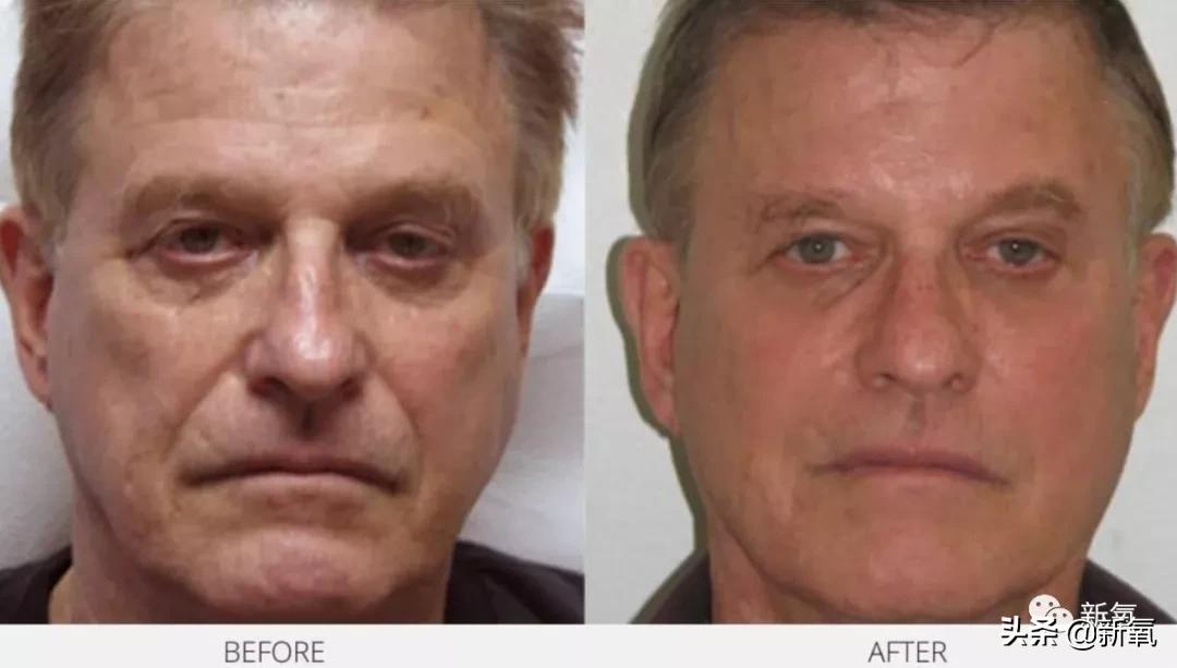 How much does the drooping corner of the mouth affect the face? - iNEWS