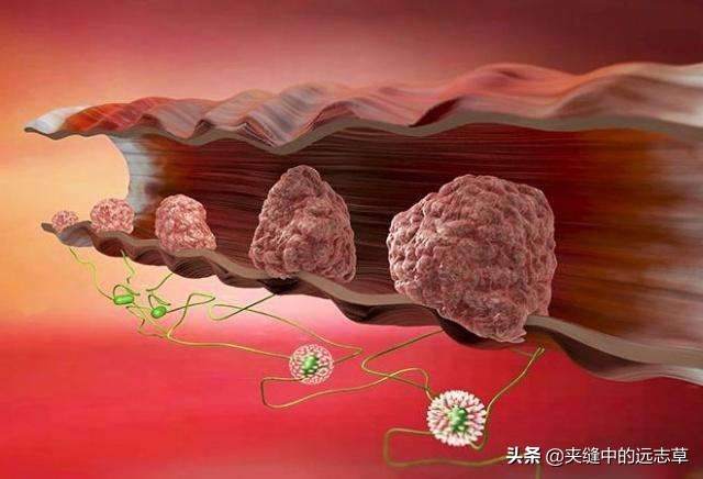 polyp?Send you four traditional Chinese medicines, all the way to ...