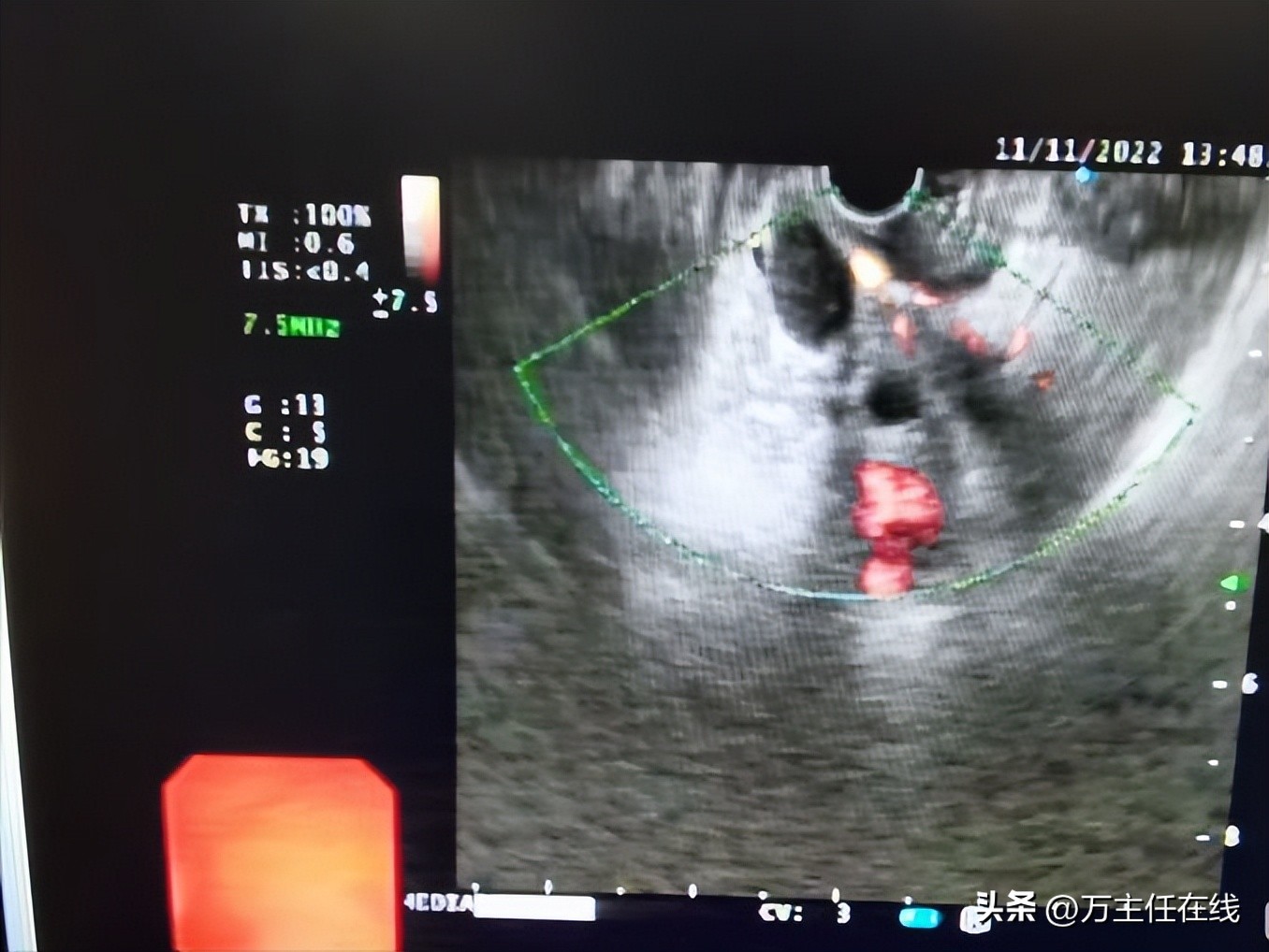 Professor Yi Wanrong from Shanghai successfully relieved a patient with ...