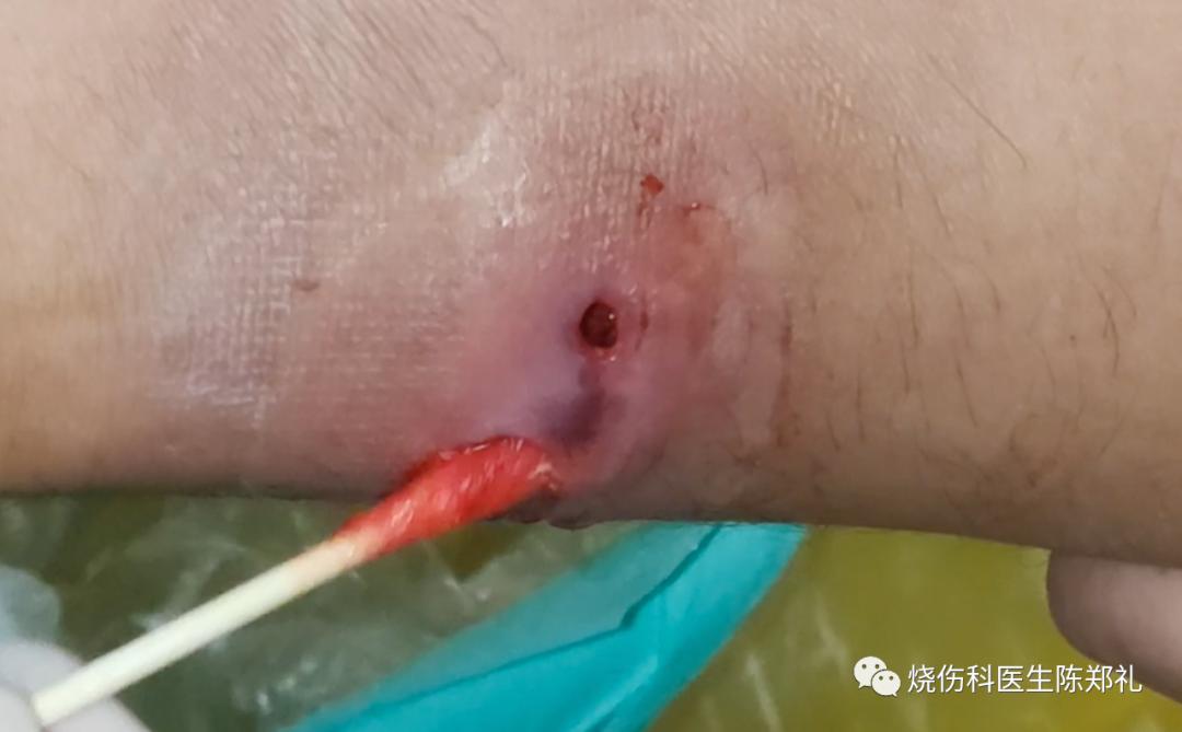 Treatment of chronic refractory wounds - iNEWS