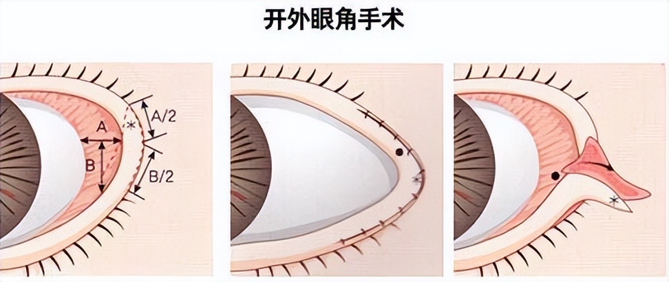 The distance between the eyes is close, can the inner corner of the eye ...