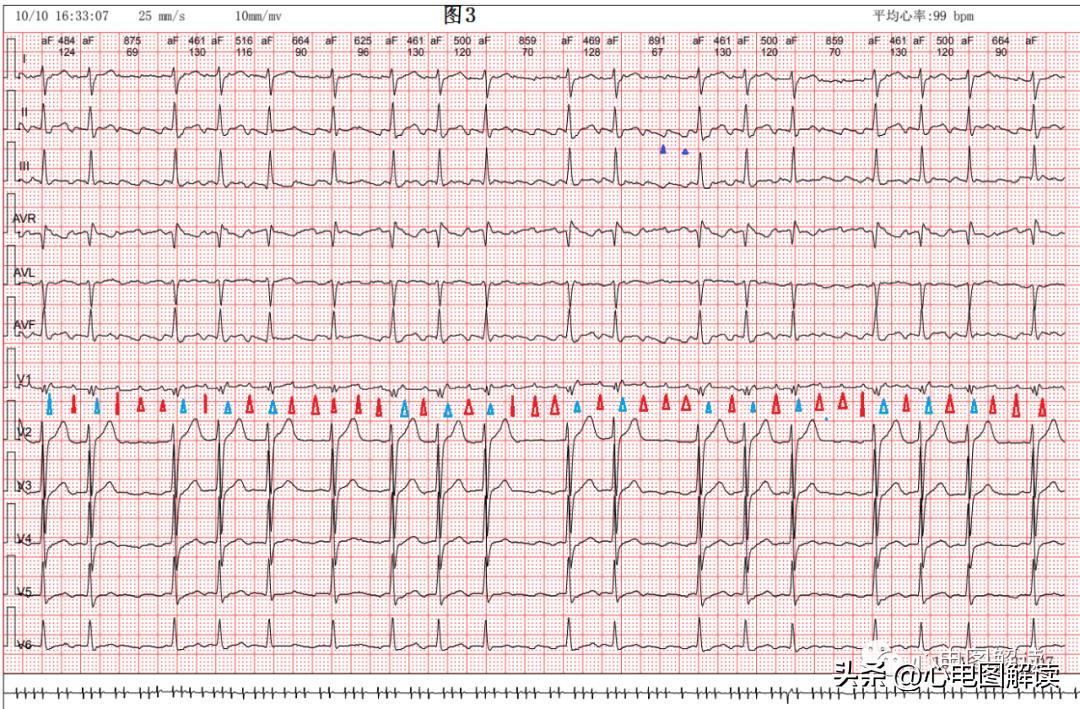 Atrial fibrillation?Atrial flutter?Scatter plot - iNEWS