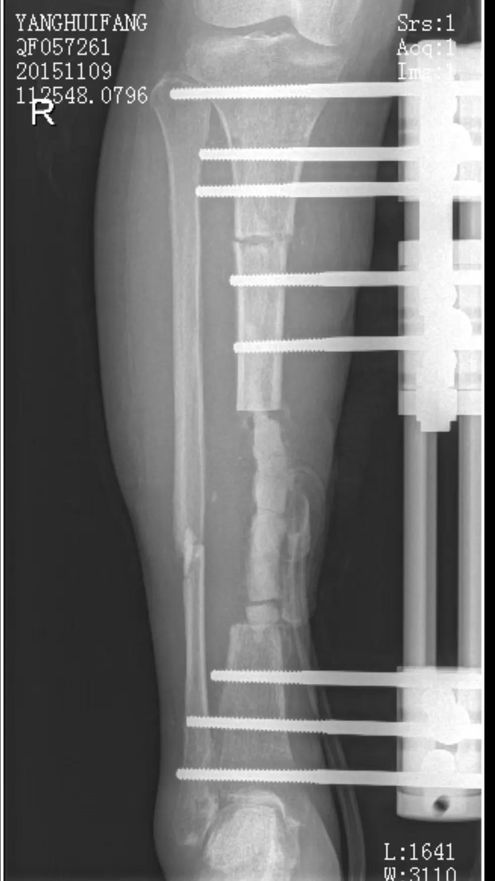 Soft tissue - what to do with bone infection - iMedia