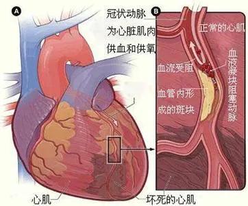 heart rupture due to myocardial infarction - iNEWS
