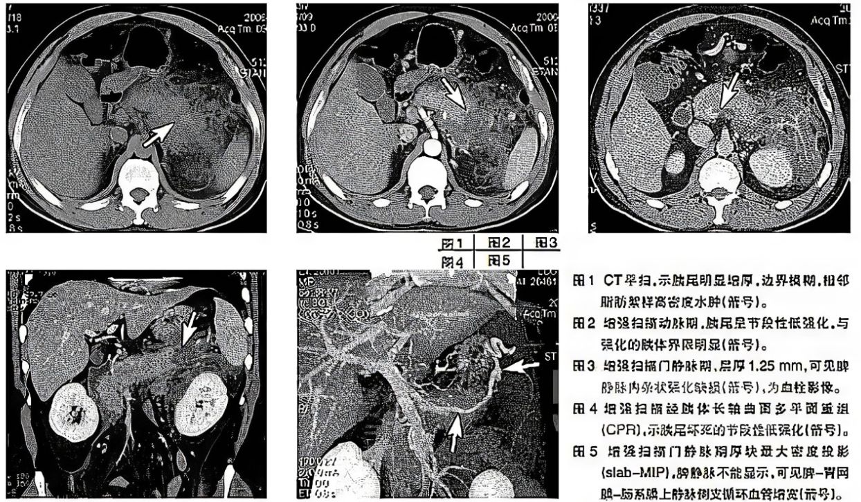 How to distinguish splenomegaly from hypersplenism?An article to let ...